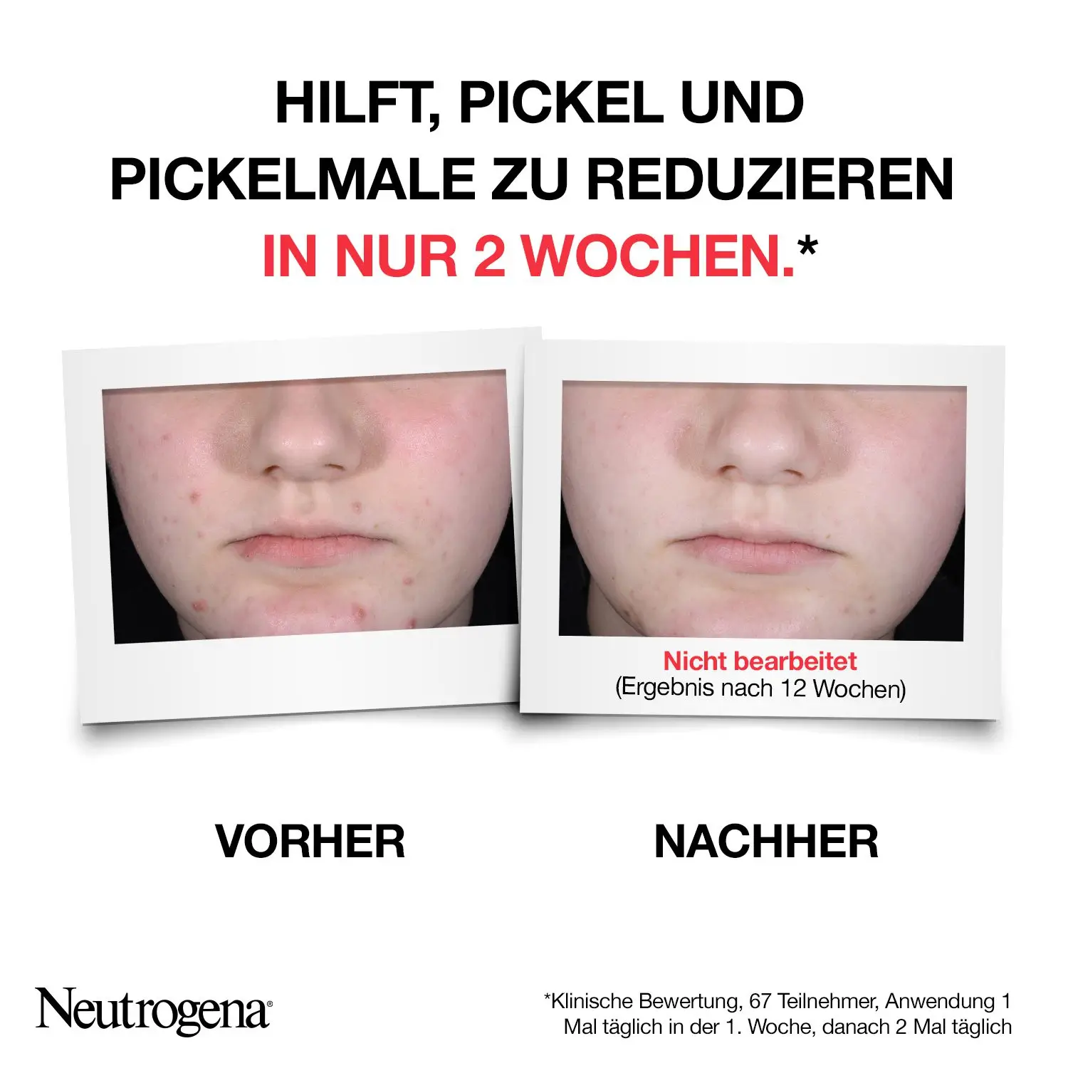 Anti Pickel+ Peeling Serum | NEUTROGENA®